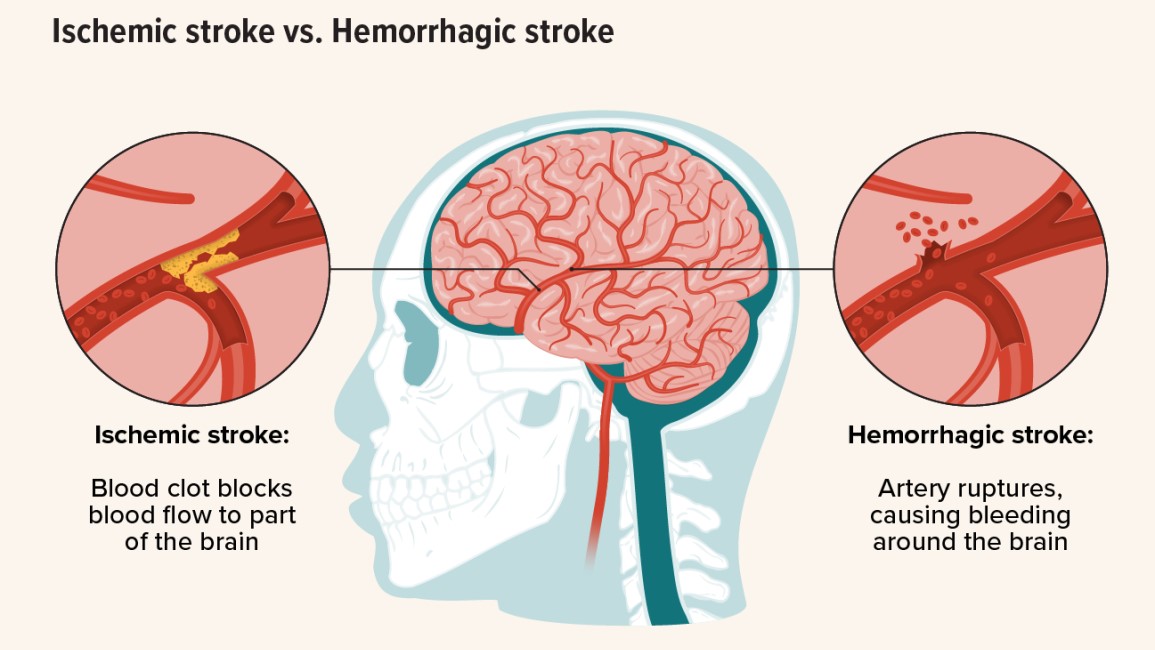 Stroke Management: A Comprehensive Guide to Stroke Care